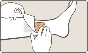 Cinesteam®, An effective secondary dressing for malodorous wounds